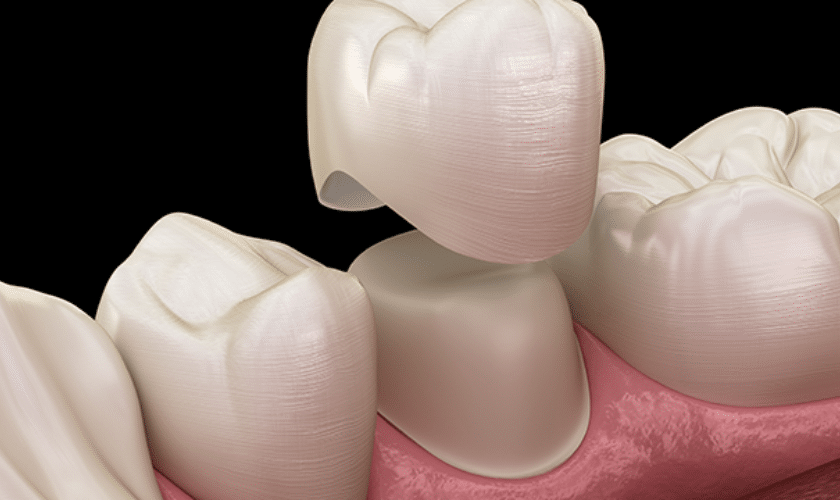 Explaining The Gap Behind Your Dental Crown And How To Fix It | Wicker ...